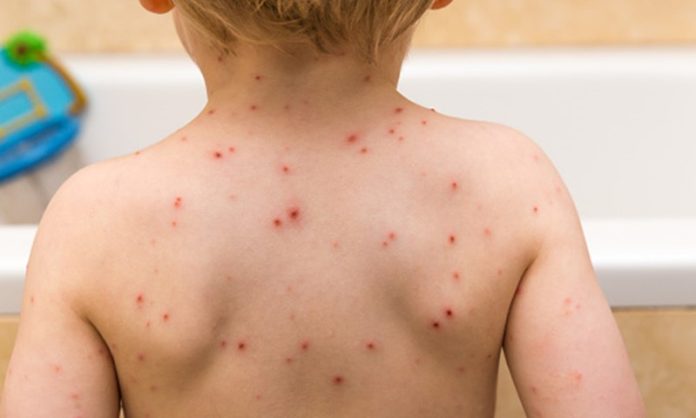 Chicken Pox vaccine shold be added to routine child immunisations says ...