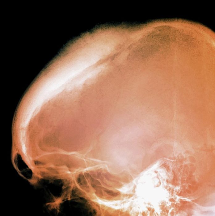 NHS to roll out first targeted treatment for rare childhood brain ...